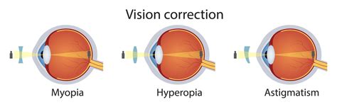 Myopia And Astigmatism