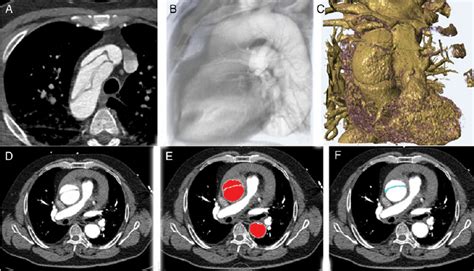 Three Dimensional 3d Reconstruction Of The Aortic Dissection Download Scientific Diagram