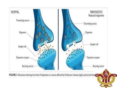 Parkinsons Disease And Pathophysiology Pptx