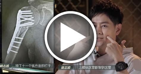 林志颖首曝车祸x光照 鼻到下巴都断裂 Nestia