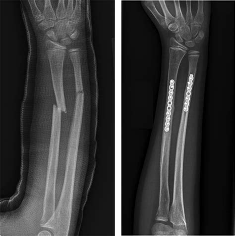 Uneven Arm Bone Fracture