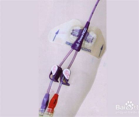 Picc置管后六大并发症处理 患者