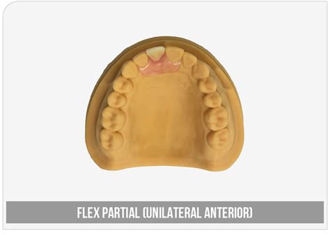 Flex Partial Unilateral Anterior Solutions Dental Lab