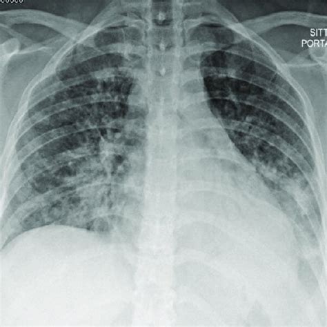 Hazy Fluffy Ill Defined Shadowing Infiltrating Both Lung Fields With A Download Scientific