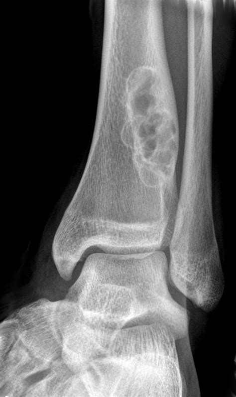 Non Ossifying Fibroma Wikipedia Non Ossifying Fibroma Wikipedia