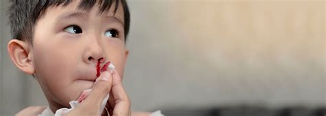 How To Treat Nosebleeds Types Causes And Treatment