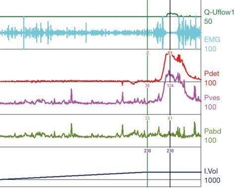 Urodynamic And Physiologic Patterns Associated With The Common Causes