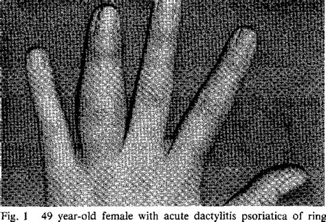 Figure 1 From Differential Diagnosis Of Acute Dactylitis Psoriatica