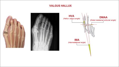Distal Metatarsal Articular Angle