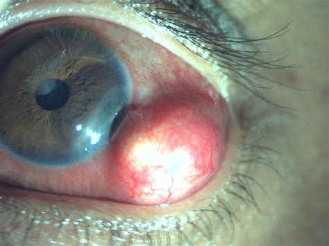 Nodular Scleritis