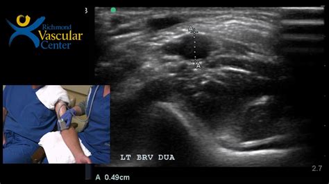 Dialysis Fistula Ultrasound Radiology