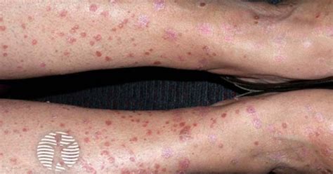 Guttate Psoriasis Image