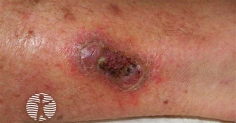 Leg Ulcer Image