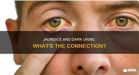 Jaundice And Dark Urine Whats The Connection Medshun
