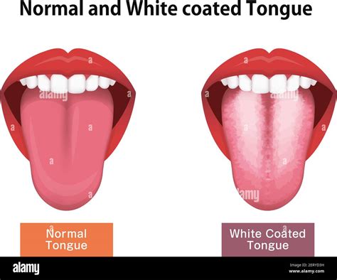 White Coating On Tongue Medical Term At Betty Kennedy Blog