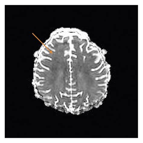 Adc Mapping With An Area Of Low Signal Intensity Left Image Orange Download Scientific Diagram