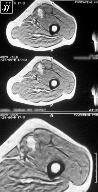 Msk Proximal Thigh Hematoma Radioogle