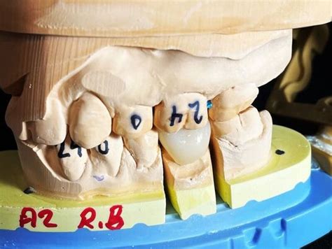 Crown And Bridge Workflow