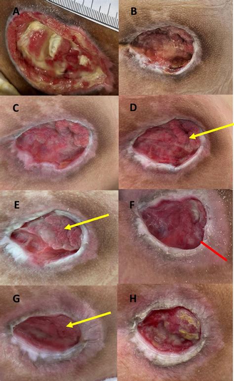 Granulation Wound Coloring Pages 2025