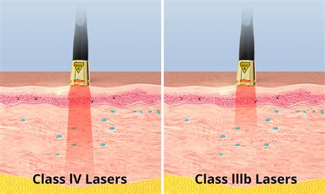 The Truth About Class Iv Lasers Matelaser