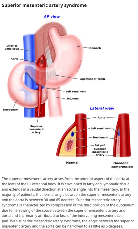 Sma Syndrome Superior Mesenteric Artery Syndrome 상장간막 동맥 증후군 네이버 블로그