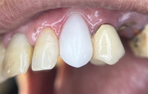 Using Flap Techniquecrown Lengthening Has Been Done And Building Up