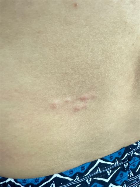 왼쪽허리에 두드러기낫어요 지식in