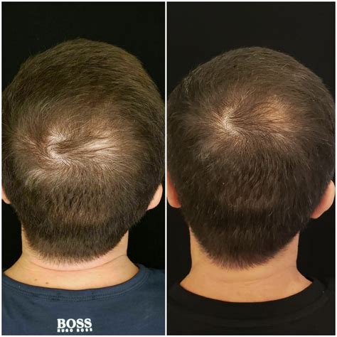 Prp Hair Restoration How Does It Work And Is It Permanent My Botox