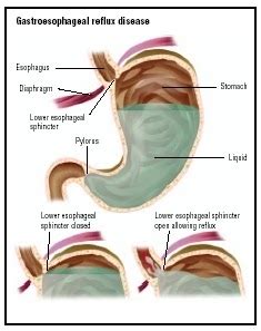 Acid Reflux Gerd Lower Esophageal Sphincter