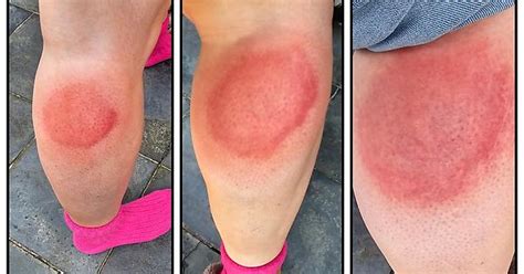 Mosquito Bite Fun Album On Imgur