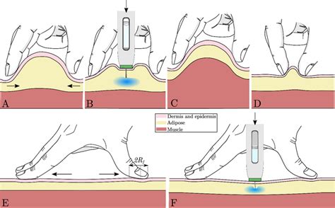Subcutaneous Injection Mastering Subcutaneous Injections A