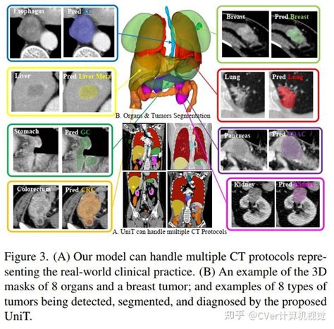通用肿瘤transformer来了！unit：检测、分割和诊断八种主要癌症的通用模型 知乎