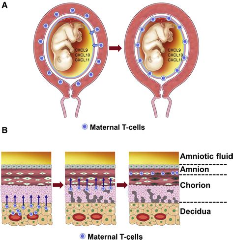 Chronic Inflammation Of The Placenta Definition Classification