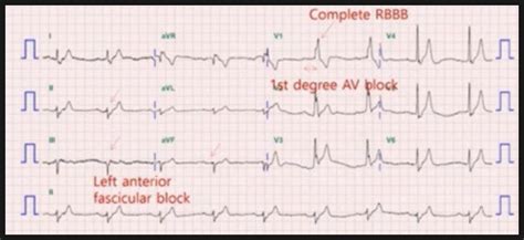 Trifascicular Block 위험할 수도 있는 심전도 네이버 블로그