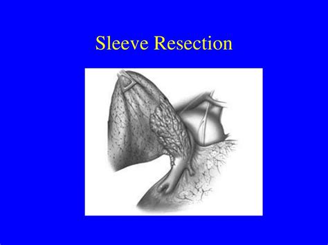 Ppt Surgical Management Of Lung Cancer Powerpoint Presentation Free