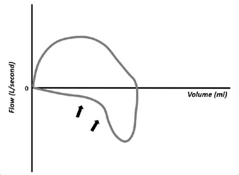 Flow Volume Curve Showing Limited Expiratory Flow E G In Download Scientific Diagram