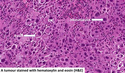 Hematoxylin And Eosin Hande Mypathologyreport
