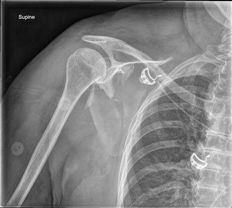 Scapula Fractures Core Em