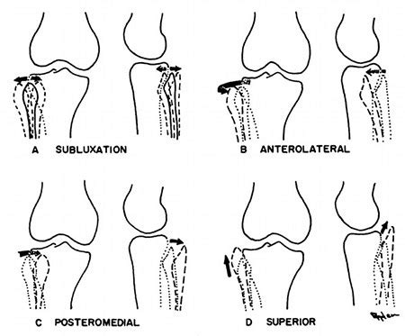 Proximal Tibiofibular Ligament Instability Bishop CA Proximal Tibiofibular Joint Instability