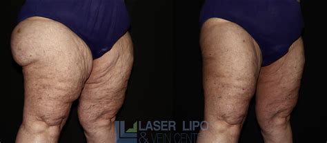 Lipedema Surgery Before And After Page 4 Of 7 Laser Lipo And Vein Center