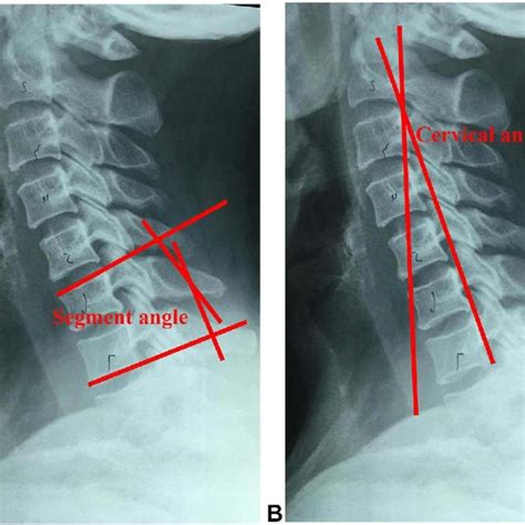 The Measurement Of Segment Angle And Cervical Angel A Segment Angle Download Scientific
