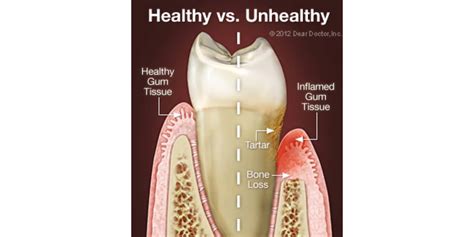 Gum Disease Treatment Dr Matthew Hong Dental Clinic Johor Bahru