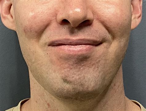 Male Face Front 1 Dr Barry Eppely Explore Plastic Surgery