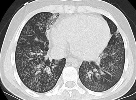 AYAT Blog Tree In Bud Sign Lung