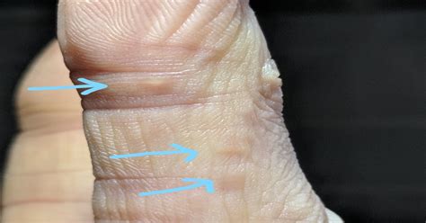 Do Palmar Punctate Keratoderma Grow Back In The Exact Same Place Dermatology