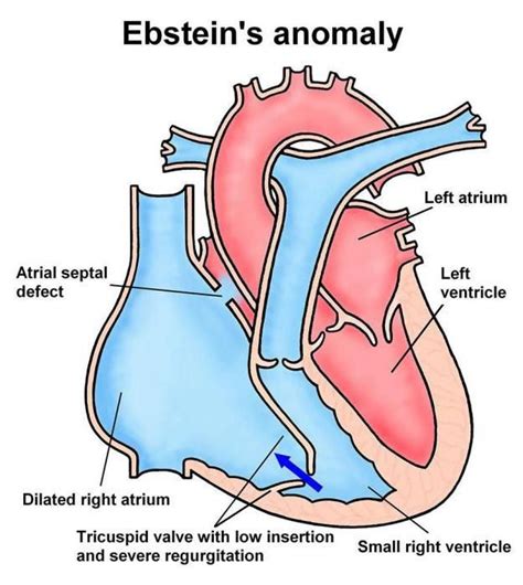Image Result For Ebstein Anomalie Ebsteins Anomaly Tricuspid Valve