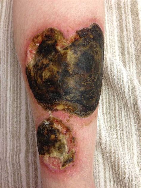 Pyoderma Gangrenosum Feb 6 2013
