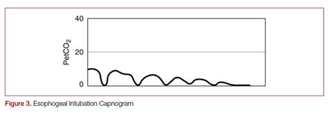 Esophageal Intubation Capnography