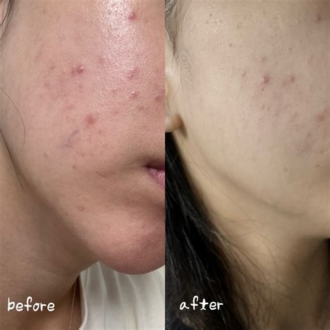 7일차 후기 🌿피부상태 저는 지성복합성피부인데 최근에 피부가 싹 뒤집어졌어요ㅜㅜ