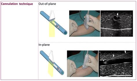 Difficult Cannulation A Practical Guide To Iv Access Medcourse